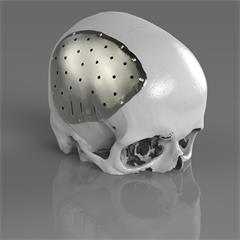 Cranial Plating